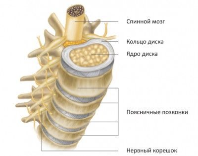What Is a Herniated Disc and the BARRICAID® Implant? - Current Medical ...